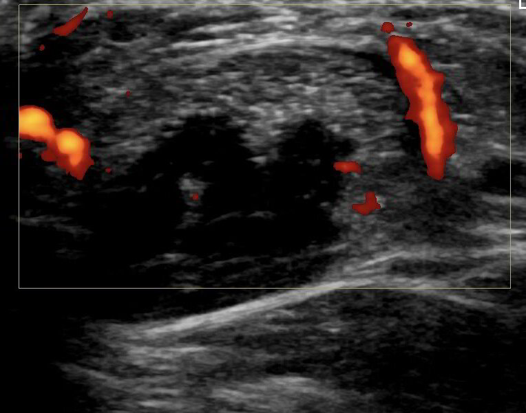 Paratendonitis