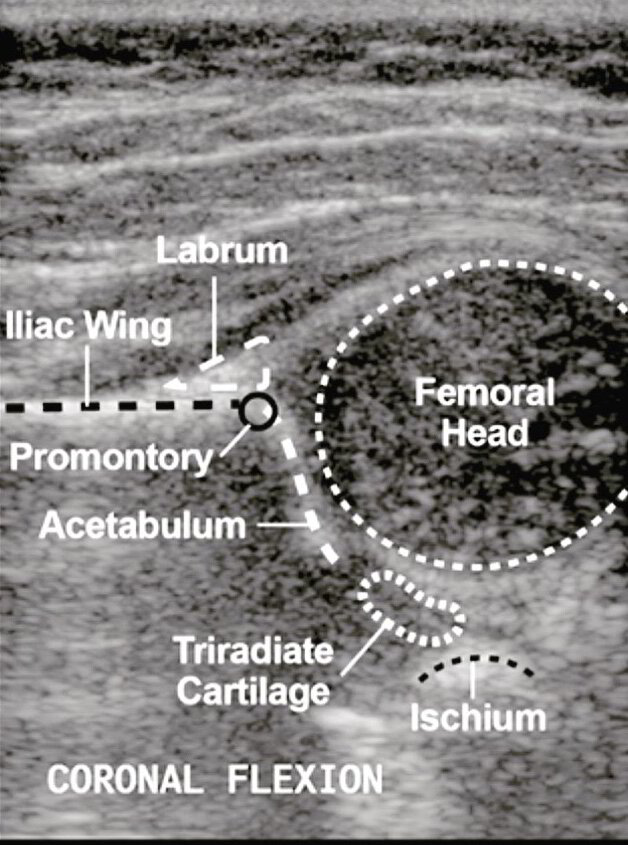 Pediatric Hip Landmarks