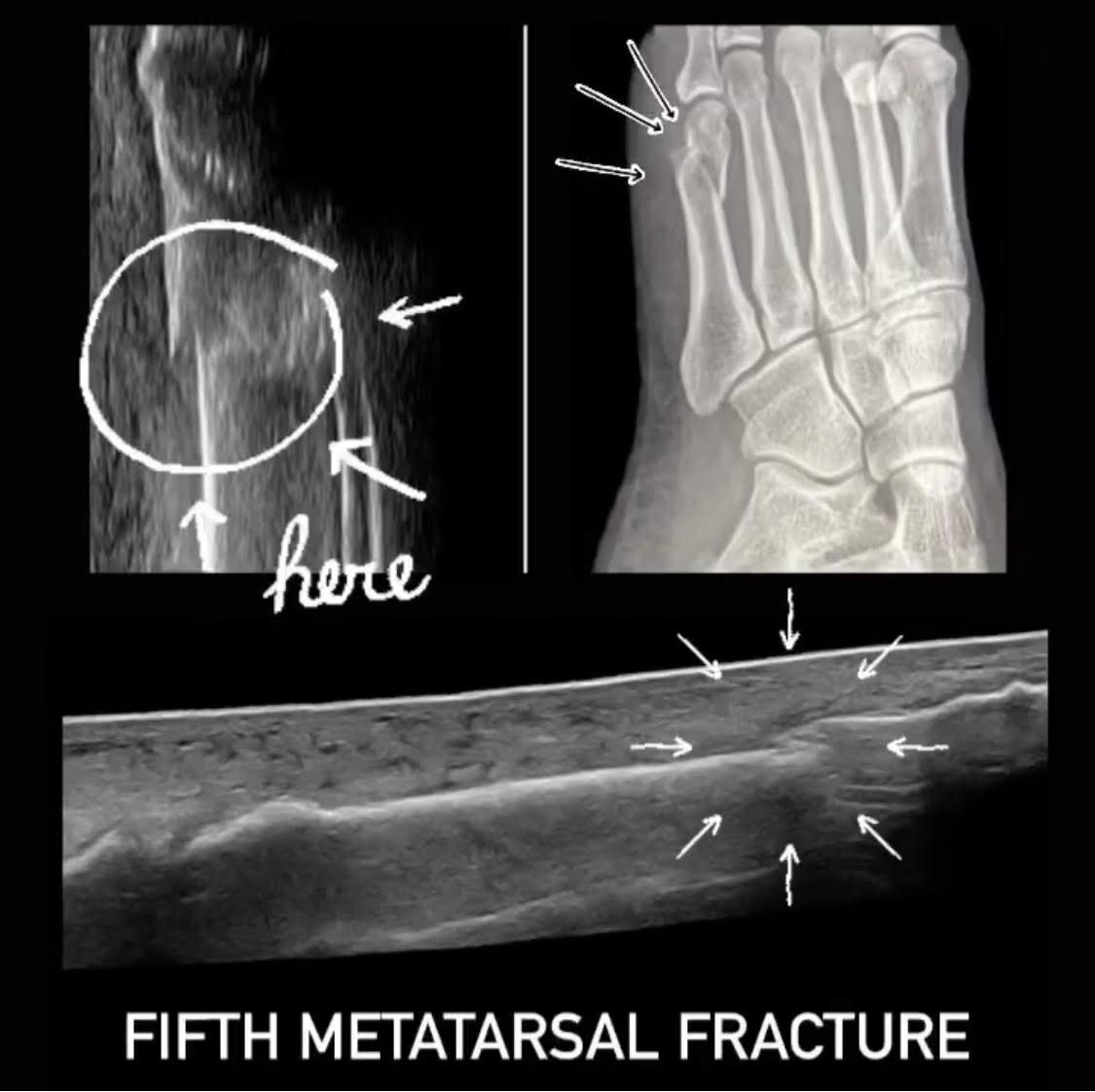 A 5th Metatarsal Fracture