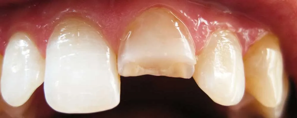 ¿Cómo arreglar una muela rota?