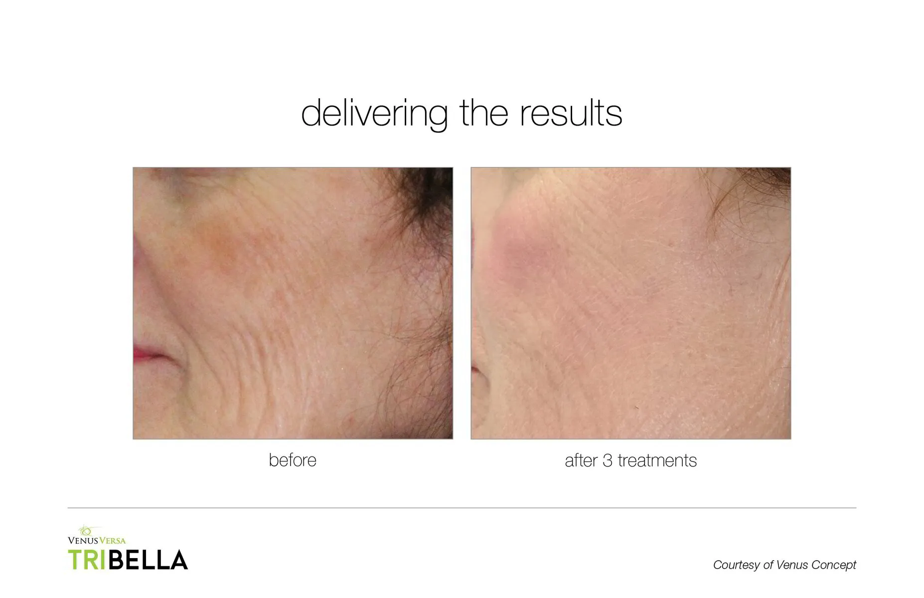 TriBella Treatment in Squamish: Comprehensive Skin Renewal at The ...