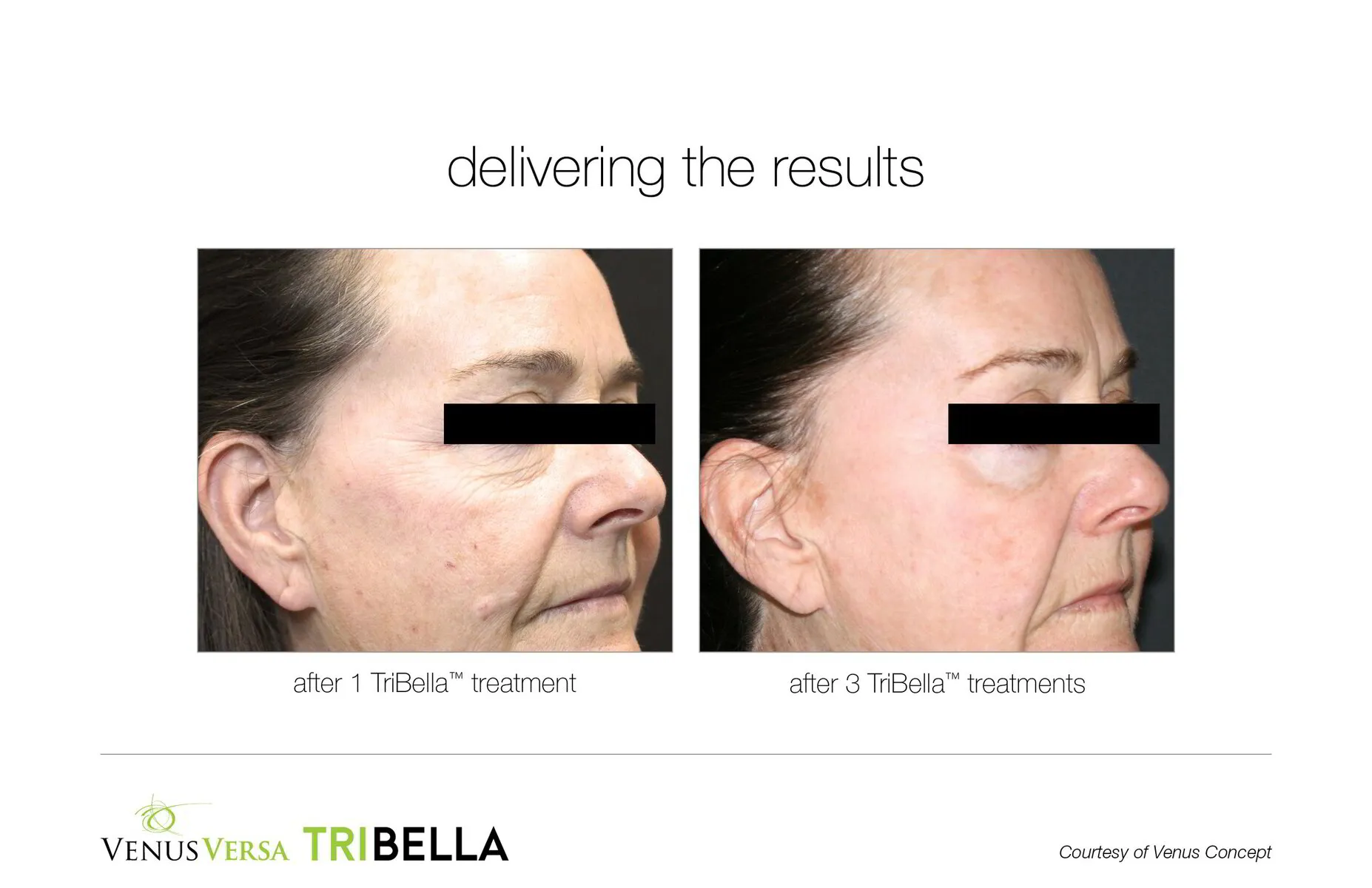 TriBella Treatment in Squamish: Comprehensive Skin Renewal at The ...