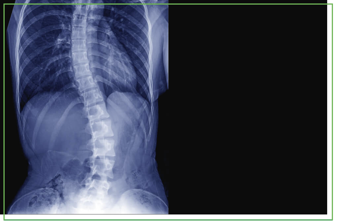 3 Common Structural Postural Distortions Of The Back