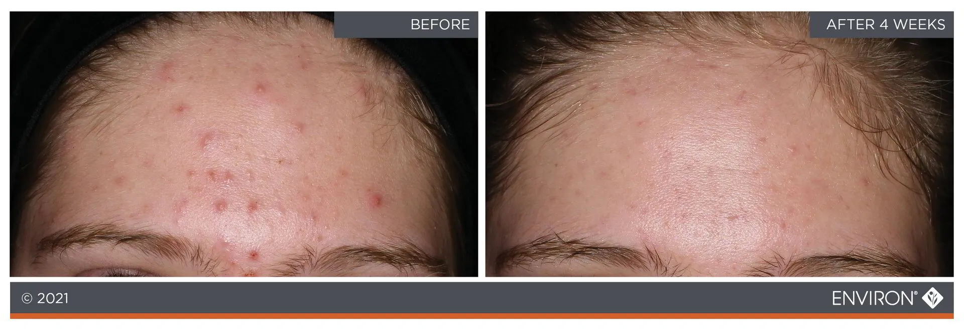 Before & After | Luxury Facial Results | Michelle’s Hidden Spa ...