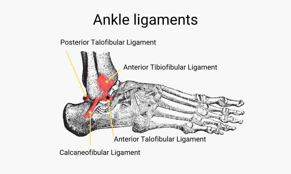 How To Manage An Ankle Sprain
