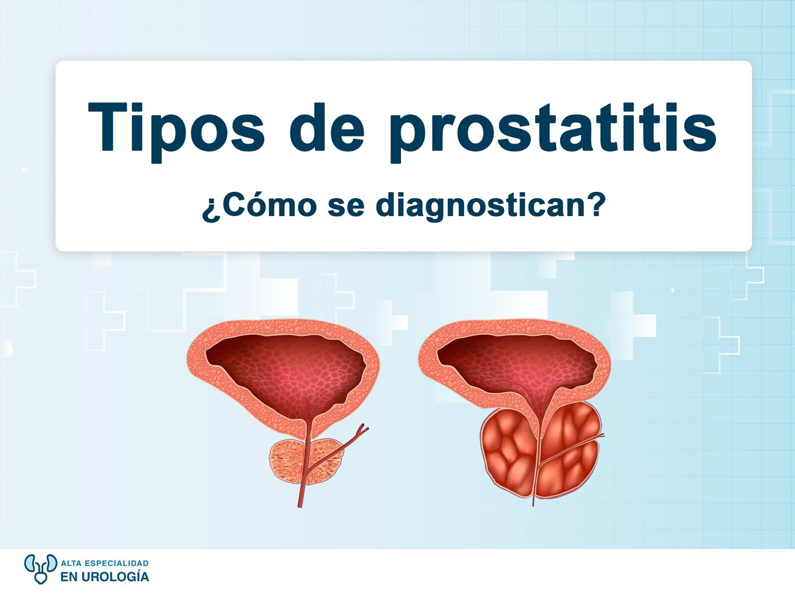 Tipos de prostatitis, ¿cómo se diagnostican?
