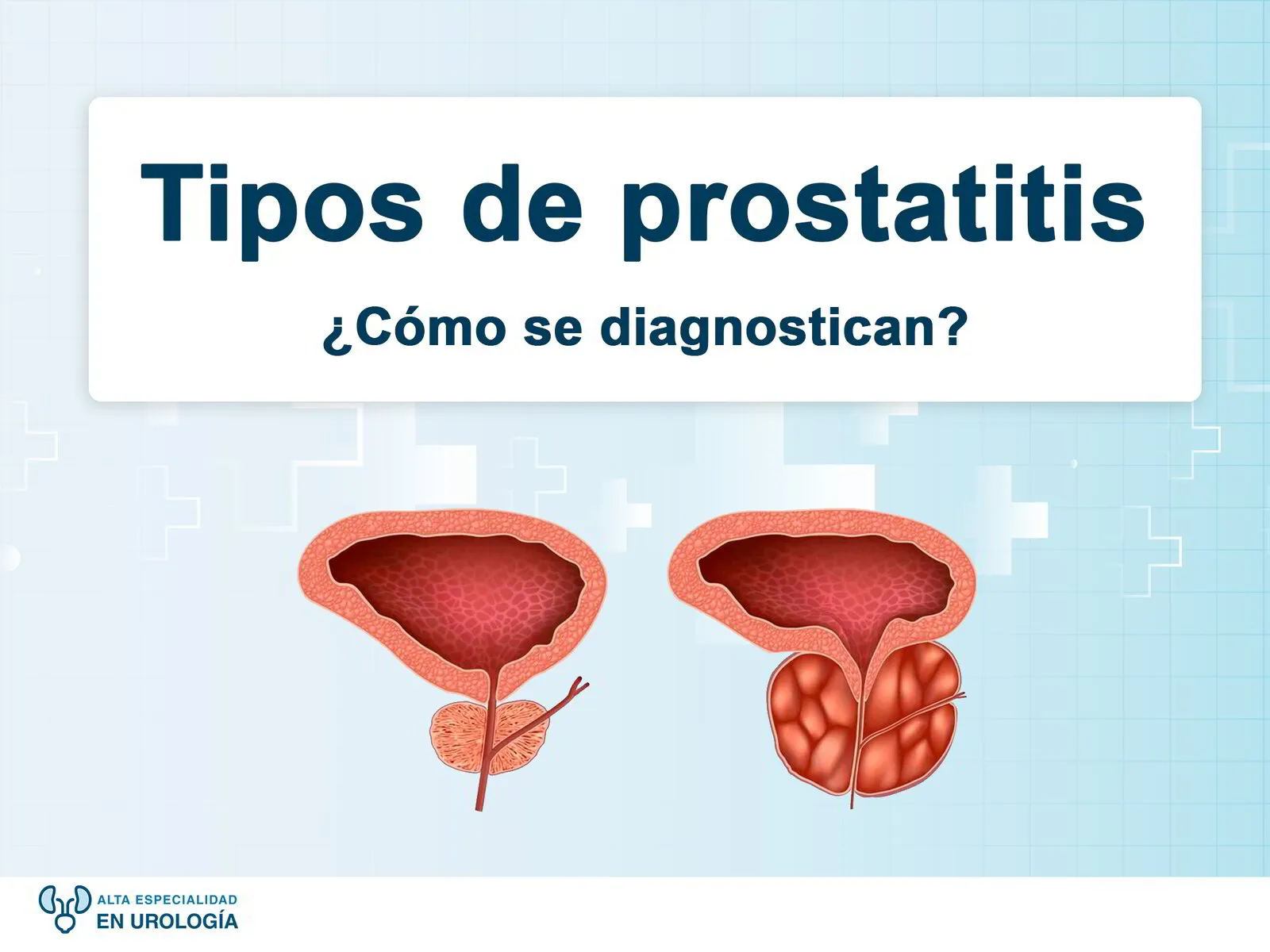 Tipos de prostatitis, ¿cómo se diagnostican?