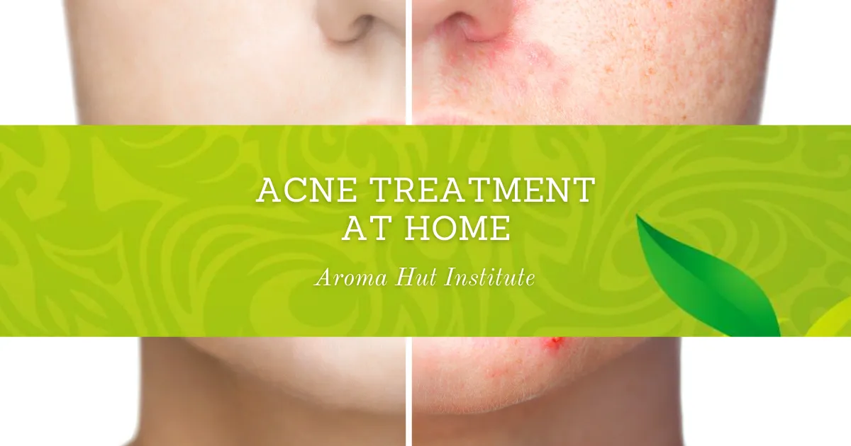 Acne Treatment At Home | Zip Zapper Essential Oil Blend