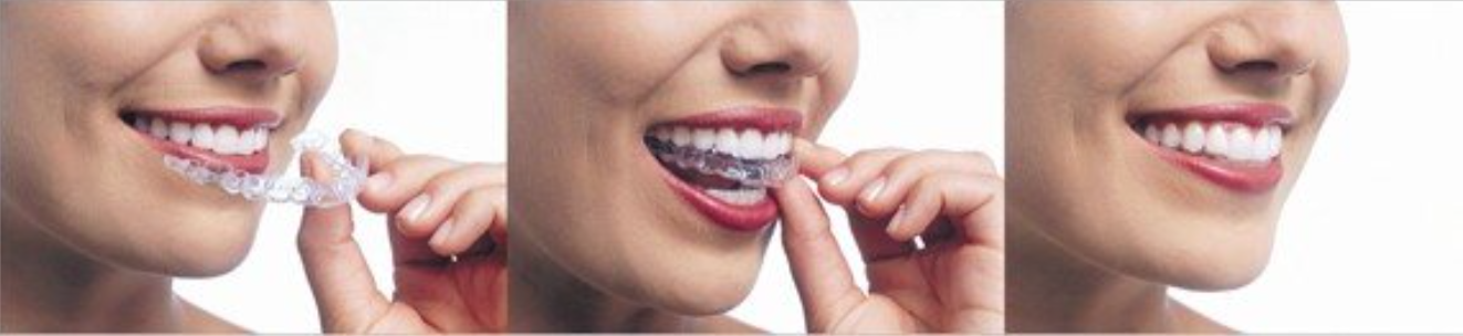 Invisalign Teeth Straitening | Bath Orthodontics
