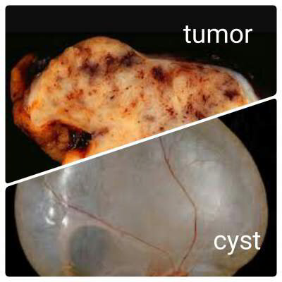 TUMOR/CYST