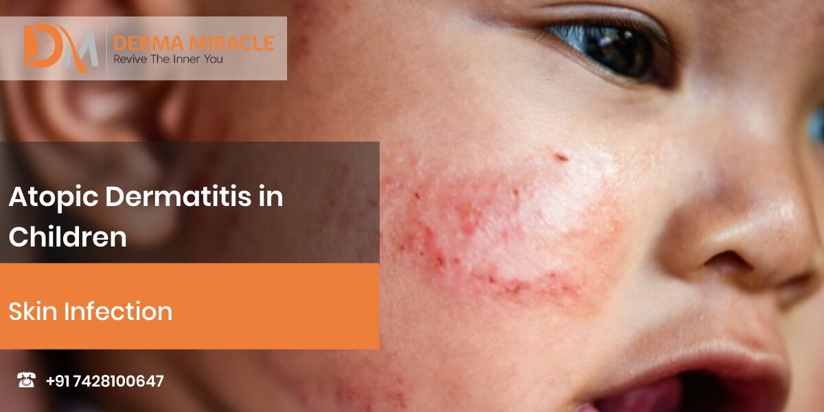 Atopic Dermatitis in Children