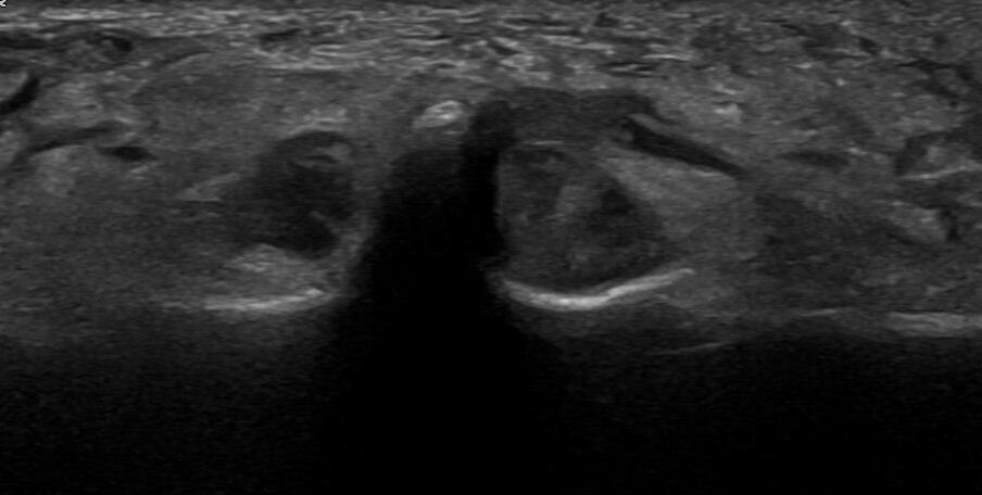 Which abnormally large bony prominence of the calcaneus can injure the ...