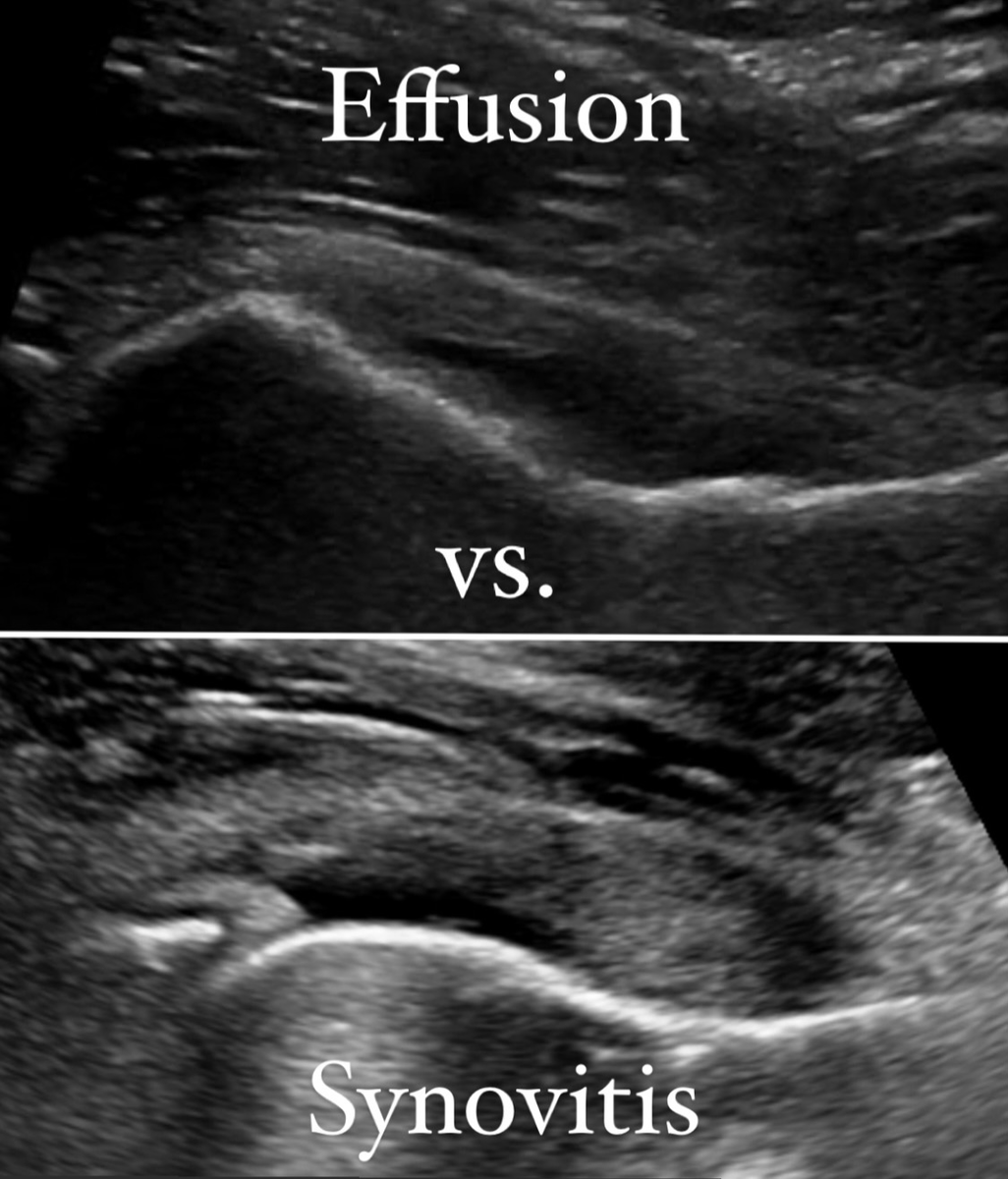 Differentiating Effusion From Synovitis: Which One Is it?