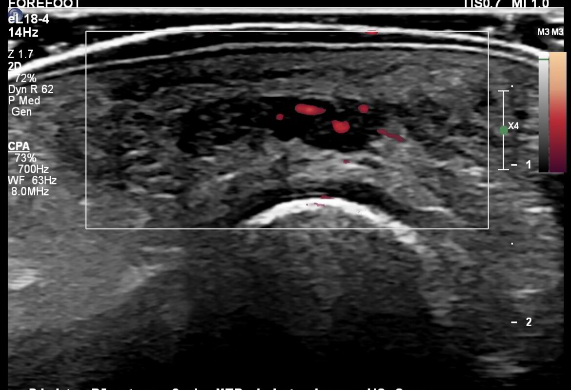 Do you know what makes an Adventitial bursa different from the native ...
