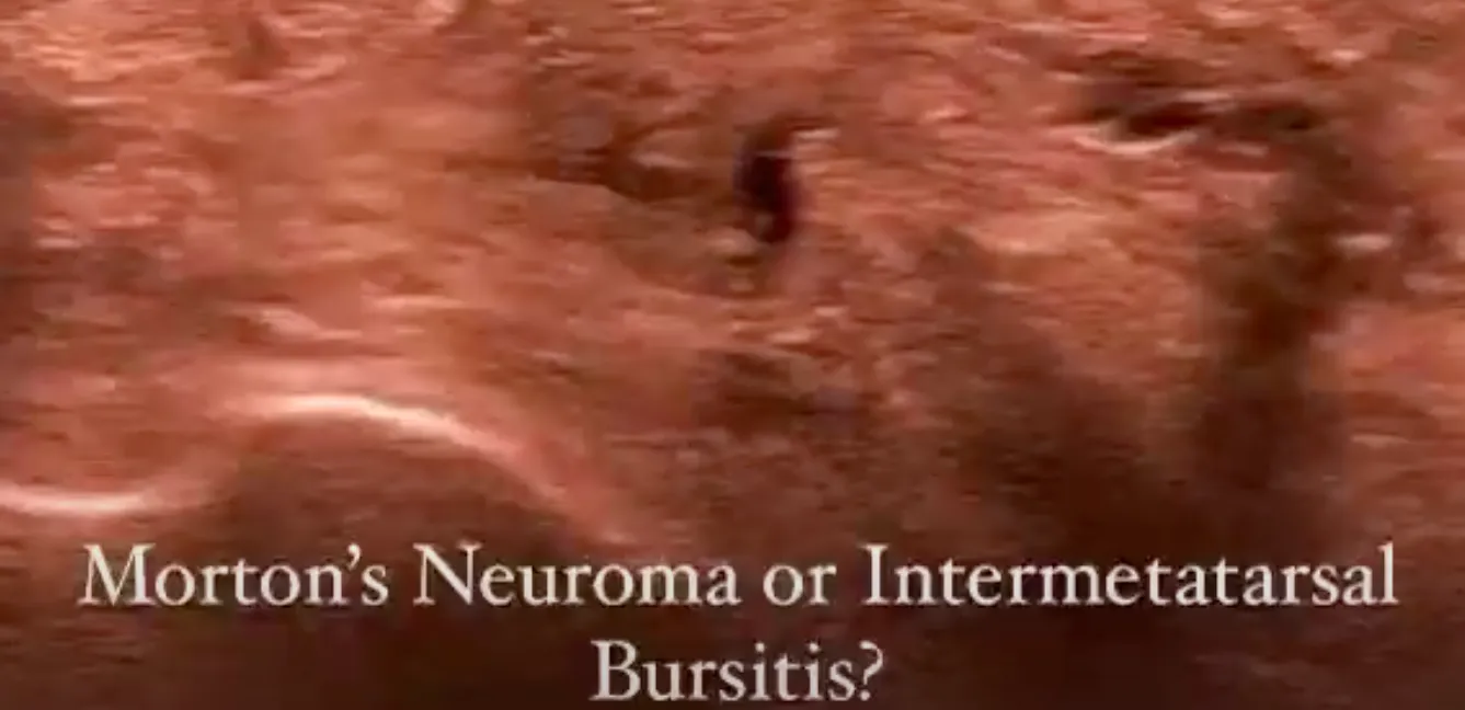 How To Diagnose Neuroma vs. Bursitis