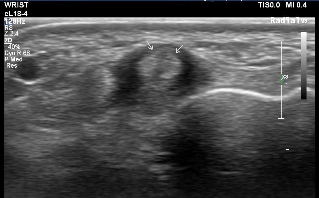 Do You Have A Snapping Sensation In Your Wrist? Read What To Do Now