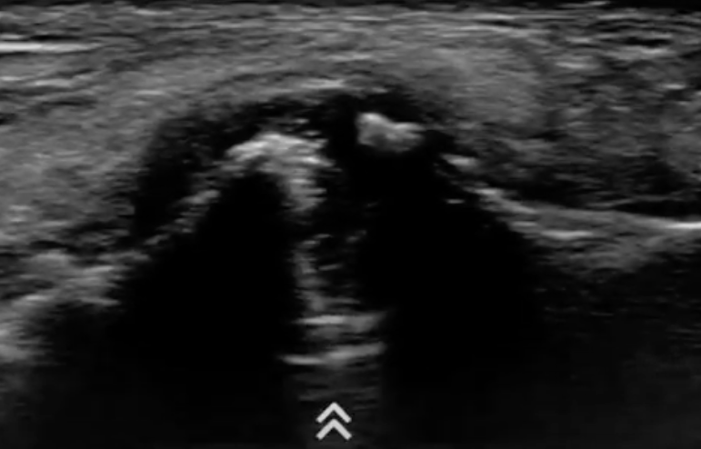 What Is The Easiest Way To Do Injection Between Joints?