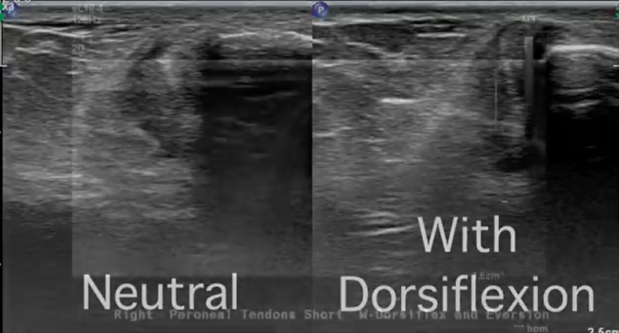 5 Steps On How You Can Identify Tendon Subluxation